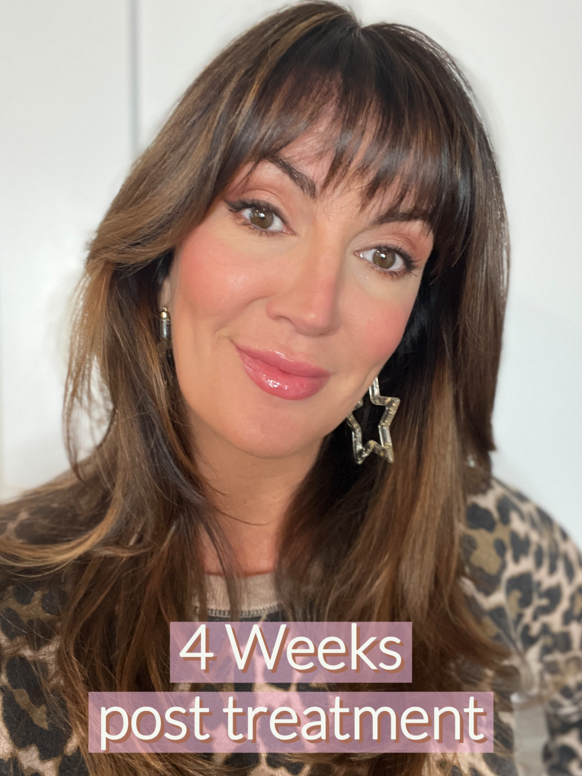 I Tried Cheek Filler For The First Time. Let's Talk About It ...